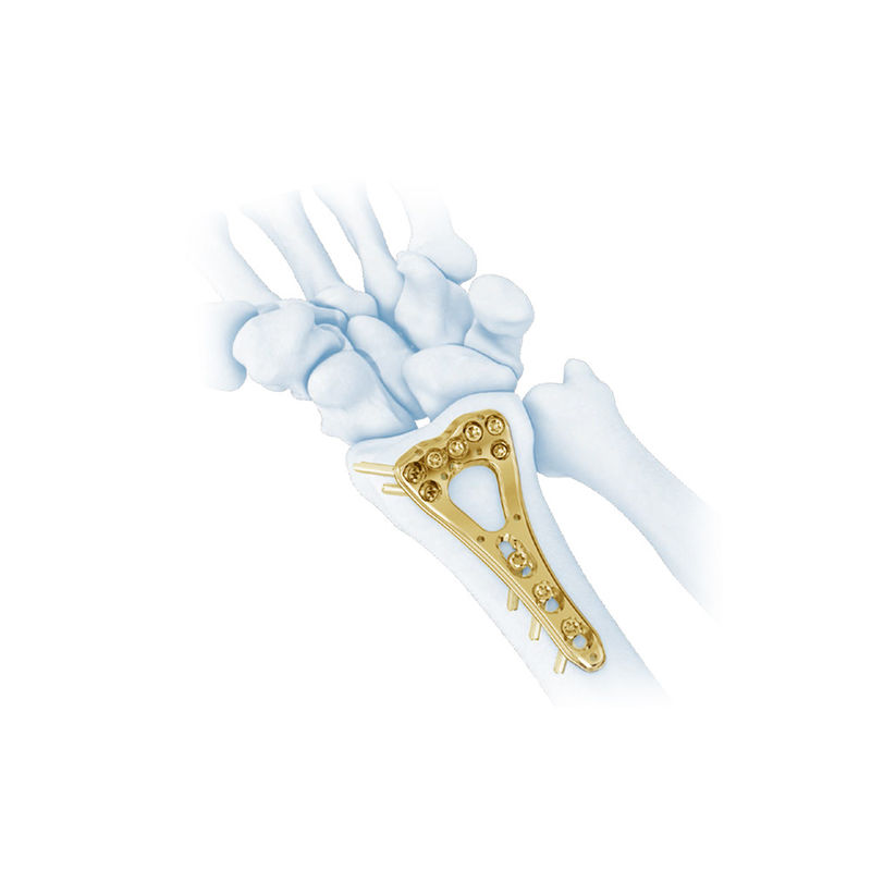 Orthopedic Medicial Plate Distal Radius Multi-axial Implants