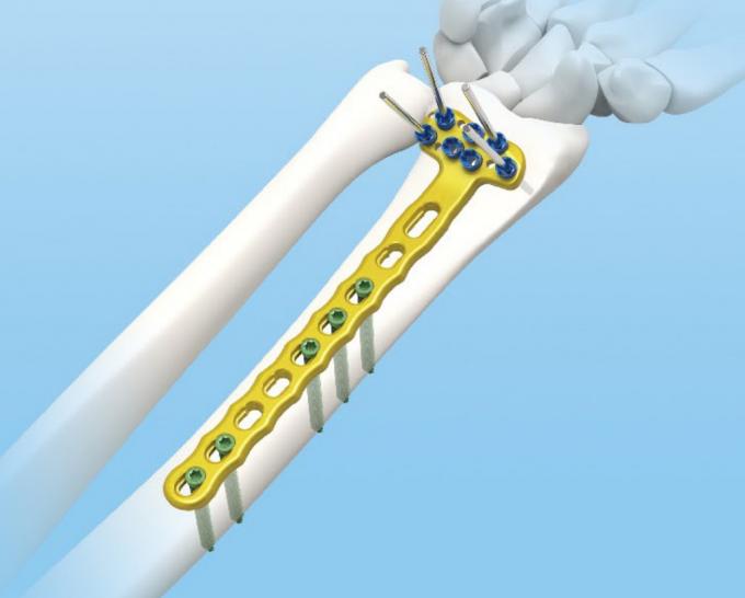 2.7mm screw Orthopedic Locking Plate Multi Axial For Distal Radius Fracture