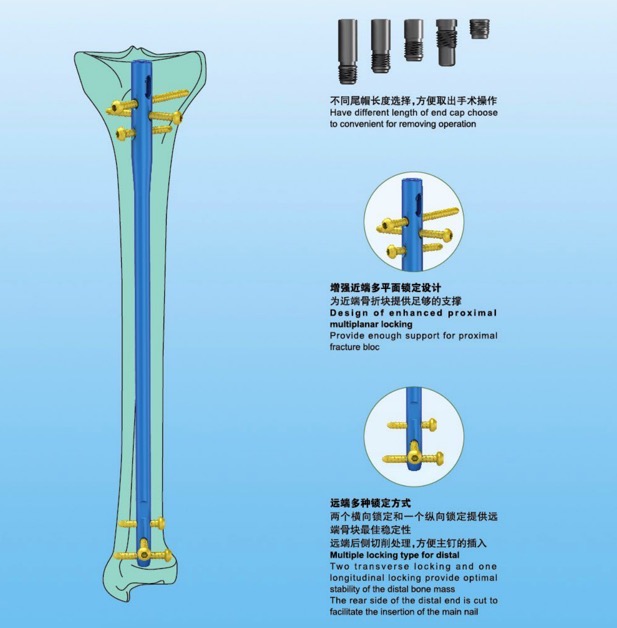 180-360mm Titanium Tibial Interlocking Nail Suprapatellar Approach