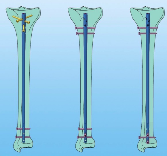 Titanium Intramedullary Nail System Proximal Tibial Interlocking Nail