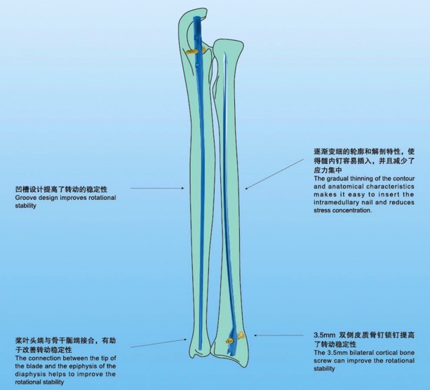 Ulna Radius Intramedullary Nail System Interlocking IM Nail Implants