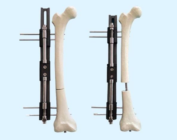 Pediatric LRS system orthofix Limb Lengthening External Fixator Pediatric LRS system orthofix Limb Lengthening External Fixator