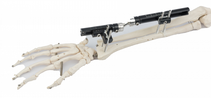 CE / ISO Orthopedic External Fixator Trauma Sterilized Fracture Distal ...