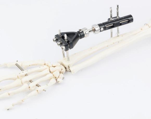 CE / ISO Orthopedic External Fixator Trauma Sterilized Fracture Distal ...