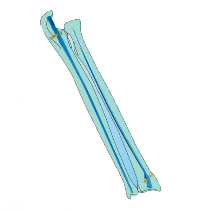 Titanium Orthopedic Implant Intramedullary Nail System Tibial Approach