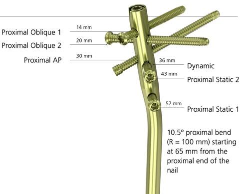 Tibial Intramedullary Interlocking Nail Titanium Orthopedic Implant